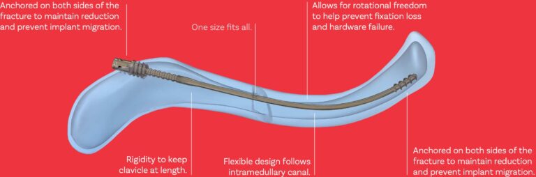 Surgeons - The Anser Clavicle Pin